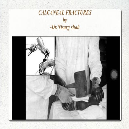 Calcaneum radiographic views | PPTX