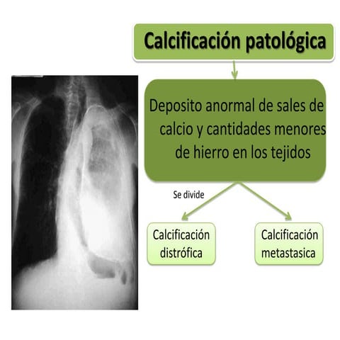 Calcificación patológica | PPTX