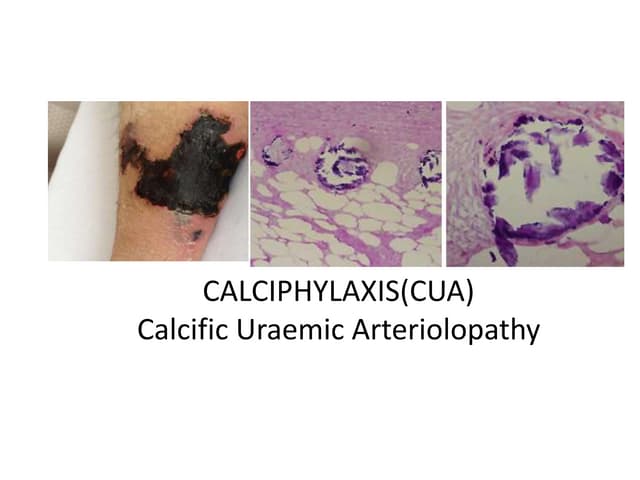 PATHOLOGICAL CALCIFICATION | PDF | Skin and Dermatology | Diseases and ...