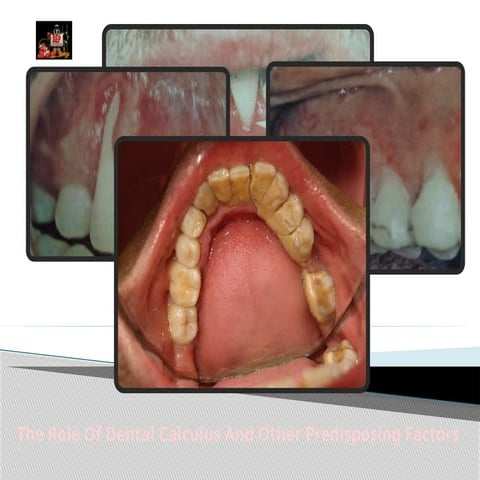 Calculus Pptx In Periodontology For Both Pptx