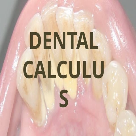 Calculus- Calcification of the plaque maturation | PPT