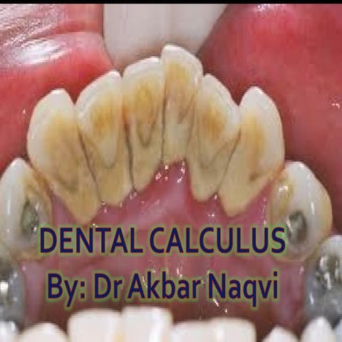 calculus in periodontics power point presentation | PPT