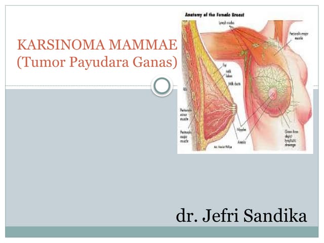 asuhan keperawatan Kanker payudara .pptx