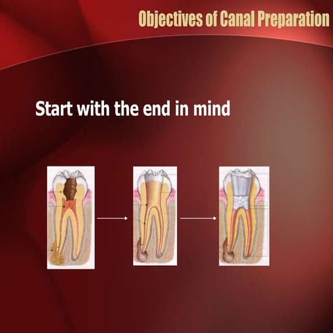 Root canal preparation techniques _ endodontic treatment | PPTX