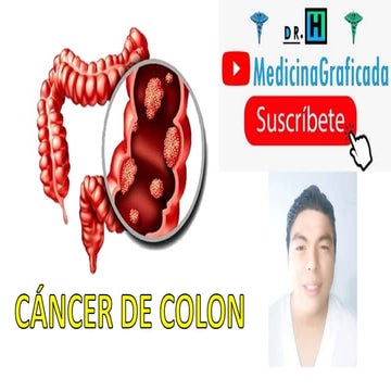 cancer de colon.pptx