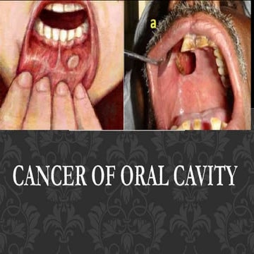 Cancer of the oral cavity | PPT