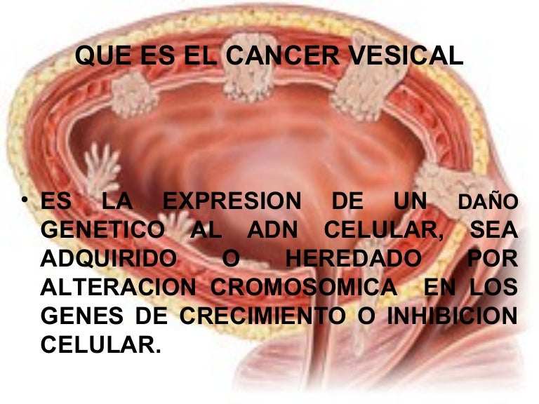 Cancer vesical