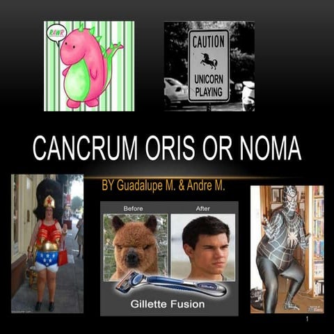 Cancrum oris or noma | PPTX