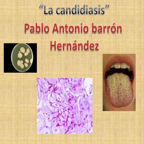 Candidiasis | PPTX