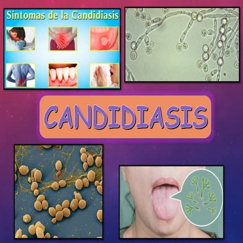 Candidiasis | PPT