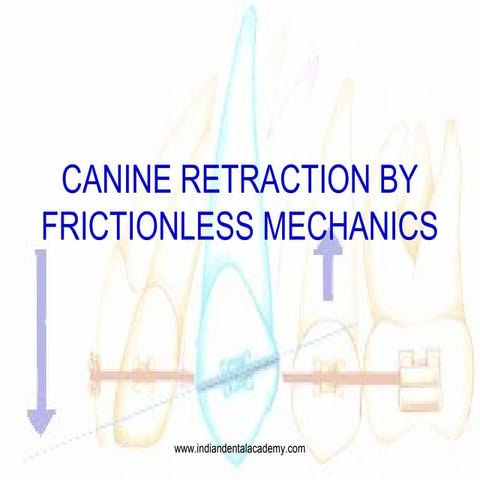 Canine retraction by frictionless mechanics | PPT