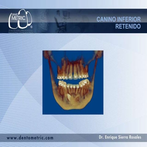 Canino inferior retenido | PPTX