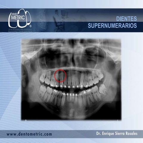 Canino supernumerario | PPTX