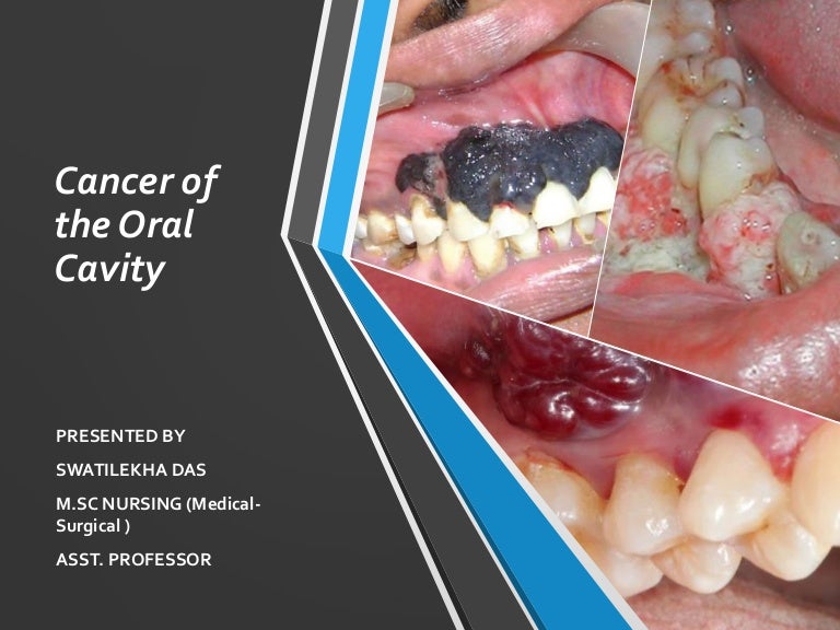 Cancer Of Oral Cavity Easy Explanation For Nurses cancer-of-oral-cavity-easy-explanation-for-nurses