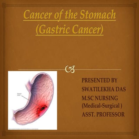 Cancer of Stomach - Easy explanation for Nurses- | PDF