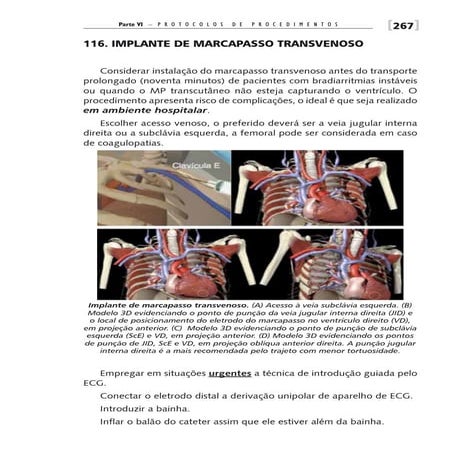Cap 116 implante de marcapasso transvenoso | PDF