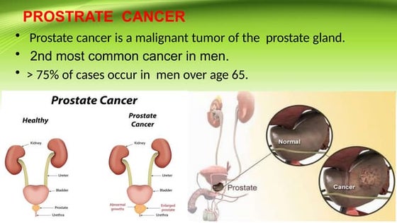 Cancer of Prostate- Easy PPT for Nursing Students | PDF