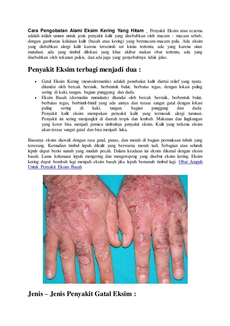 Cara pengobatan alami eksim kering yang hitam Cara pengobatan alami eksim kering yang hitam
