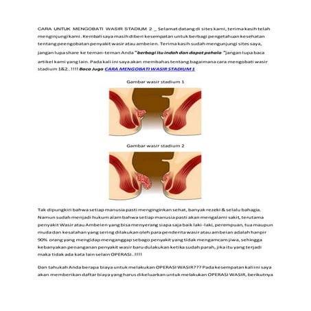 Cara untuk mengobati wasir stadium 2 | DOCX