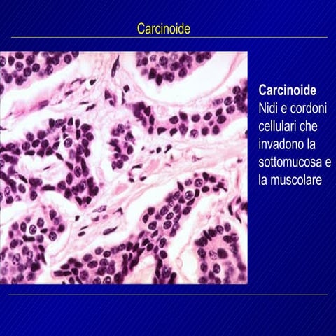 Carcinoide | PPT