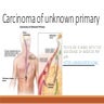 Carcinoma of unknown primary | PPTX