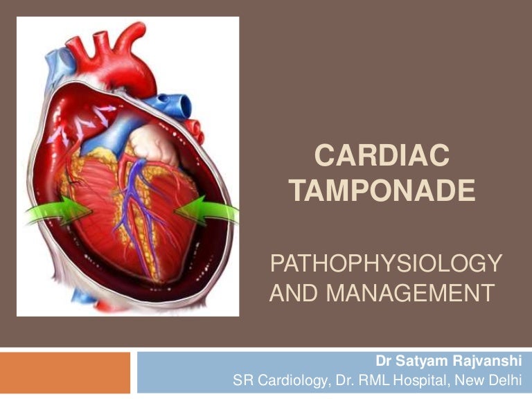 Cardiac tamponade