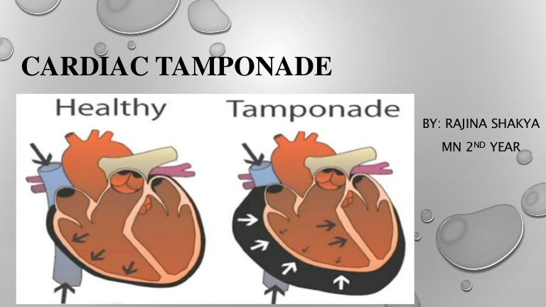 Cardiac tamponade