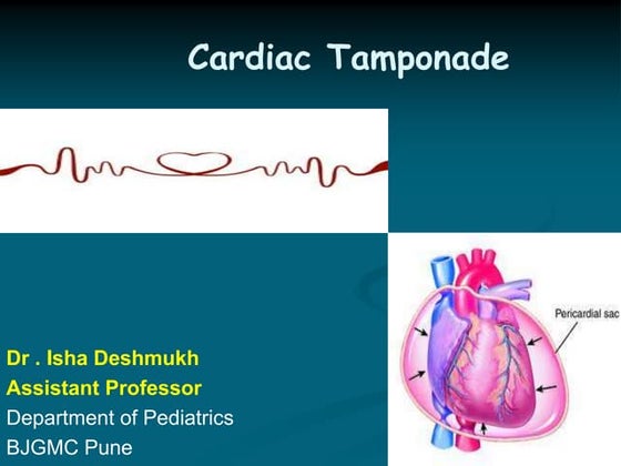 Cardiac Tamponade. presentation in detail | PPT