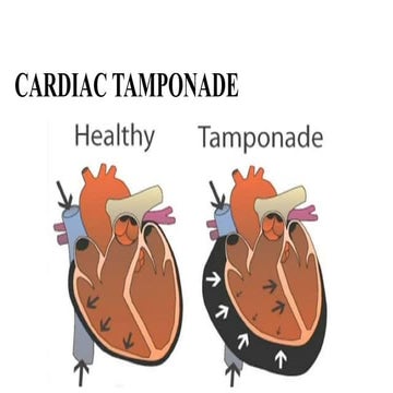 Cardiac tamponade | PPTX