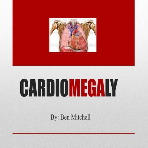 Cardiomegaly | PPTX