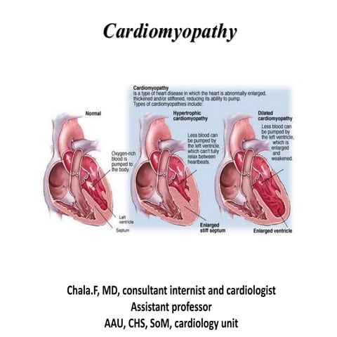 Cardiomyopathy - lecture.ppt
