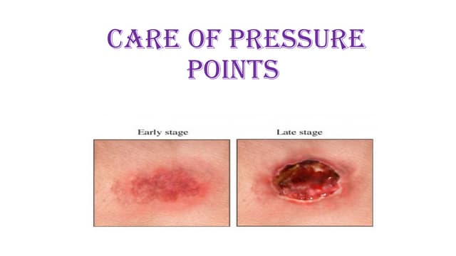Pressure sore or bed sore or decubitus ulcer ppt | PPTX
