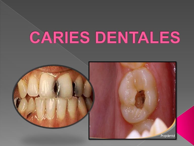 CARIES DENTAL