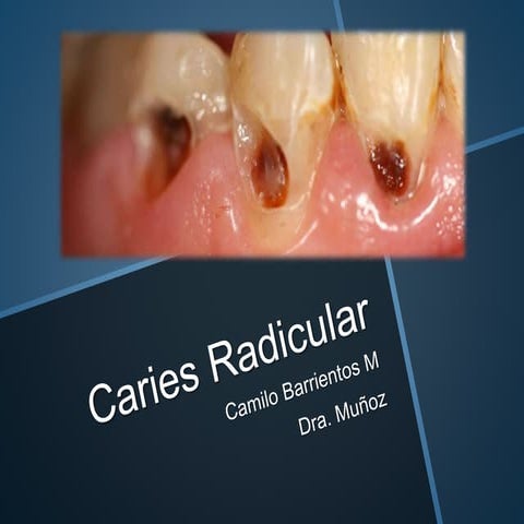 Caries radicular compl | PPT