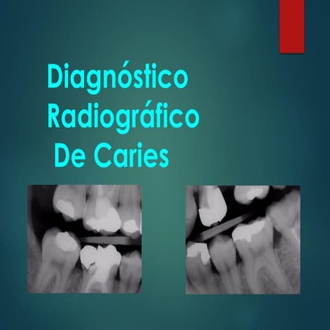 Caries radiologia | PDF