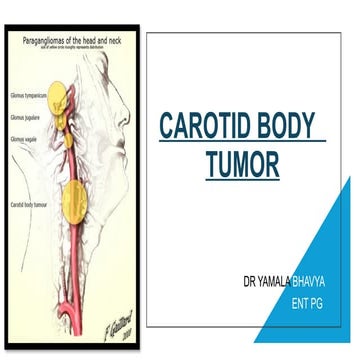 CAROTID BODY TUMOR Carotid body tumor ca | PPTX