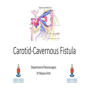 Carotid Cavernous Fistulas | PPT