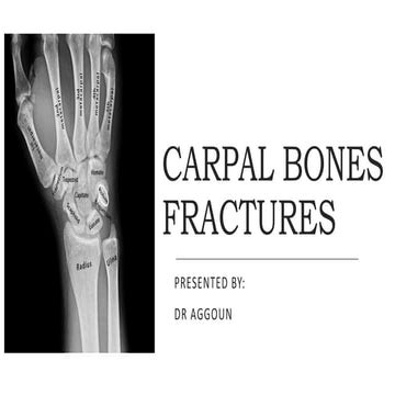 CARPAL BONES FRACTURES GENERALITES.pptx