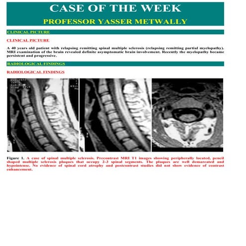 Case record...Spinal multiple sclerosis | PDF