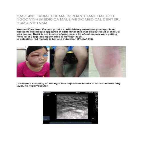 Case 430: FACIAL EDEMA, Dr PHAN THANH HẢI, Dr LÊ NGỌC VINH | DOCX