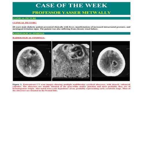 Case record...Multiple pyogenic brain abscesses | PDF