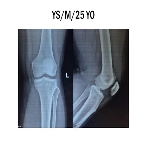 A CASE OF AN ACL RECONSTRUCTION WITH MENISCUS REPAIR .pptx