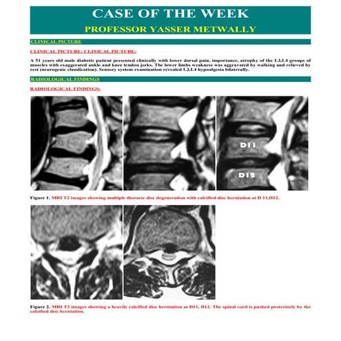 case record...Heavily calcified dorsal disc herniation at D11,D2 disc ...