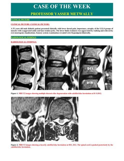 Vertebral column | PPTX