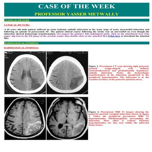 Case record...Arterial embolic hemorrhagic infarction | PDF