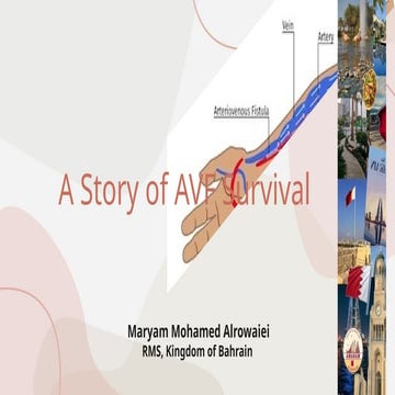 case of avf survival and Needlingw AVF for Hemodialysis patients | PPTX
