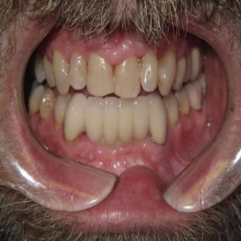 Diagnosis and Surgical Removal of Supernumerary Teeth In a 7-Year Old ...