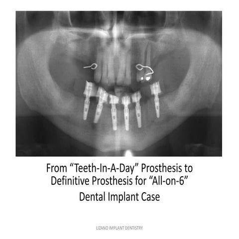 Dental Implant Case of the month: June, 2014 | PPTX