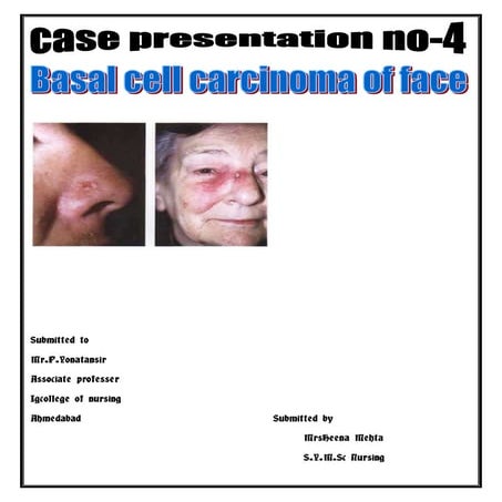 Case presentation of basal cell carcinoma of face no 4 | DOCX