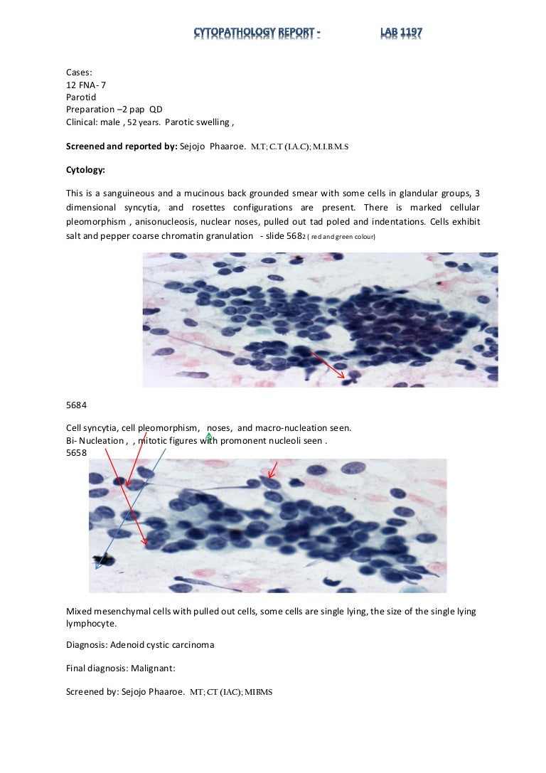 Salivary Gland Cytology Case Of Adenoid Cyst Carcinoma